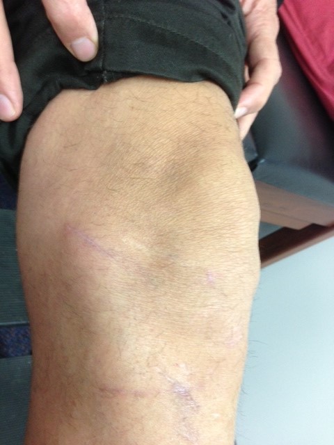 ACL/ MCL Injuries | Dr. Jens Buelow