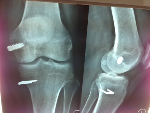 ACL/ MCL Injuries | Dr. Jens Buelow